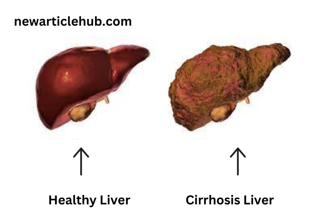 What Is Liver Cirrhosis